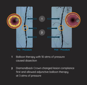 Peripheral Artery Disease Beverly Hills | PAD Treatment Los Angeles