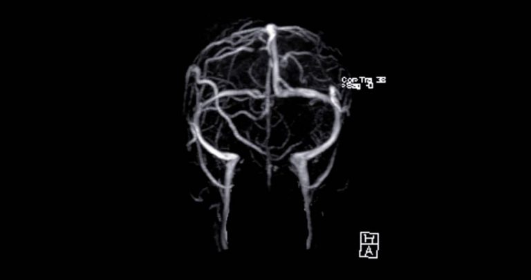 Is CT Venography Safe? - Beverly Hills Heart and Vascular Center - Blog